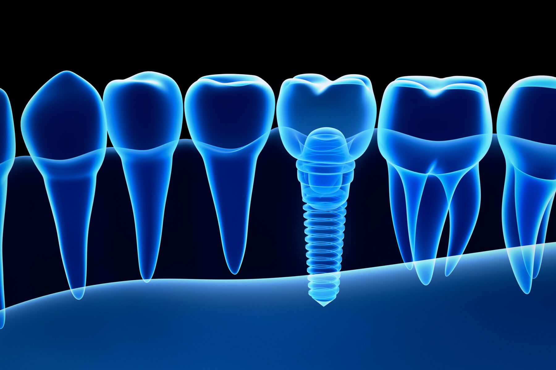 What are Dental Implants? Chester Springs PA | Dental Distinction